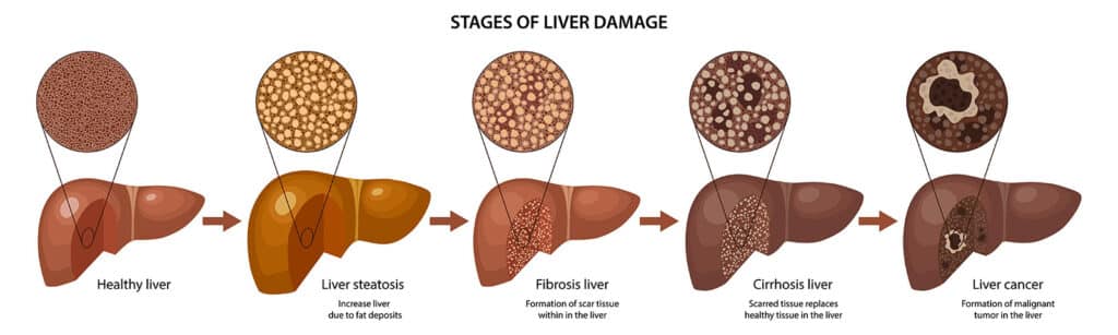 Signs Your Liver is Healing from Alcohol - Illinois Recovery Center